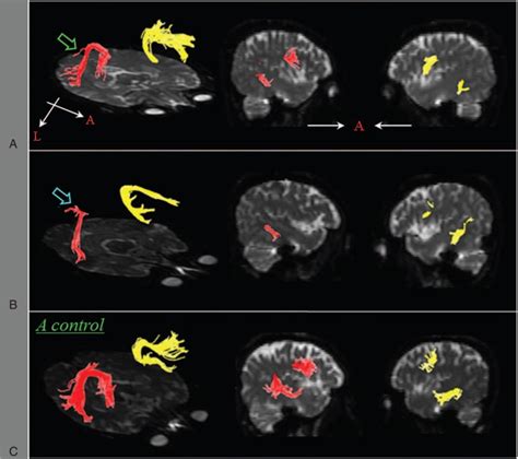 Diffusion Tensor Tractography For The Arcuate Fasciculus Right Af