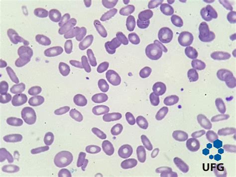 Alterações Morfológicas dos Eritrócitos Dra França