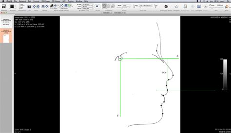 Cephalometric Soft Tissue Profile Showing The Selection Of A Movable Download Scientific