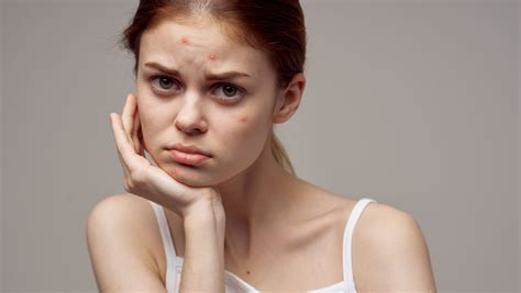 Reasons Your Acne Getting Worse