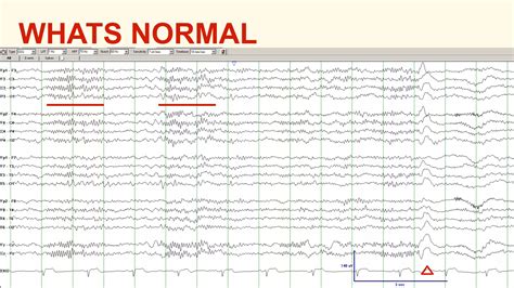 Continuous EEG In Neuro Critical Care By Brandon Foreman PDF