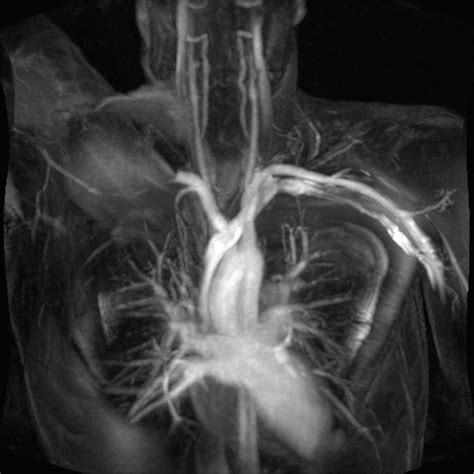 Thoracic Outlet Syndrome Testing Sergskill