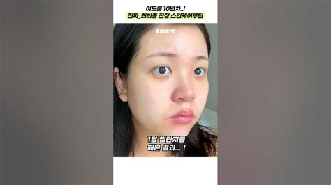 여드름 10년차 진짜최최종 진정 스킨케어루틴 Ft한달 챌린지 Youtube