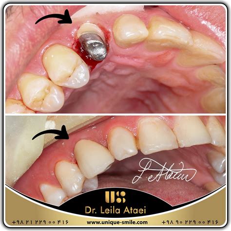 👈 برداشت Unique Smile دکتر لیلا عطایی دندانپزشک