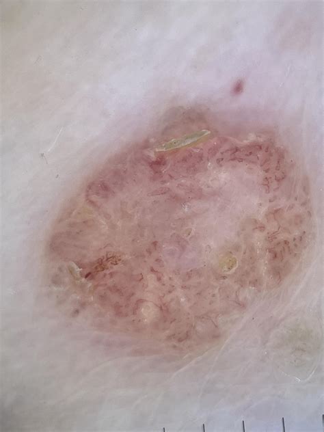 Lesion Today R Dermoscopy