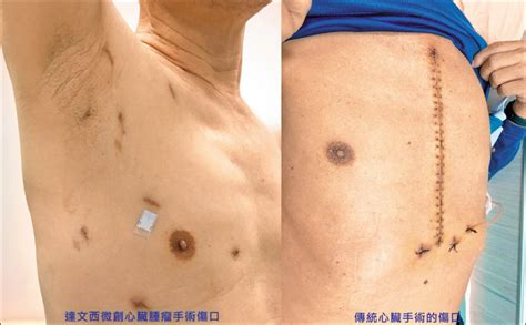 心臟8公分腫瘤 達文西手術免開胸切除 自由健康網