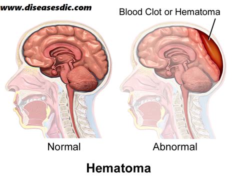 Subdural Hematoma Description Causes And Treatment