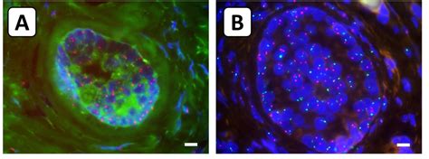 Exploring X Chromosomal Aberrations In Ovarian Cells By Using