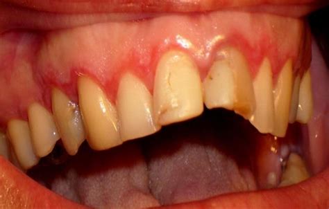 Lesión Eritematosa Que Abarca La Encía Marginal Y Parte De La Encía