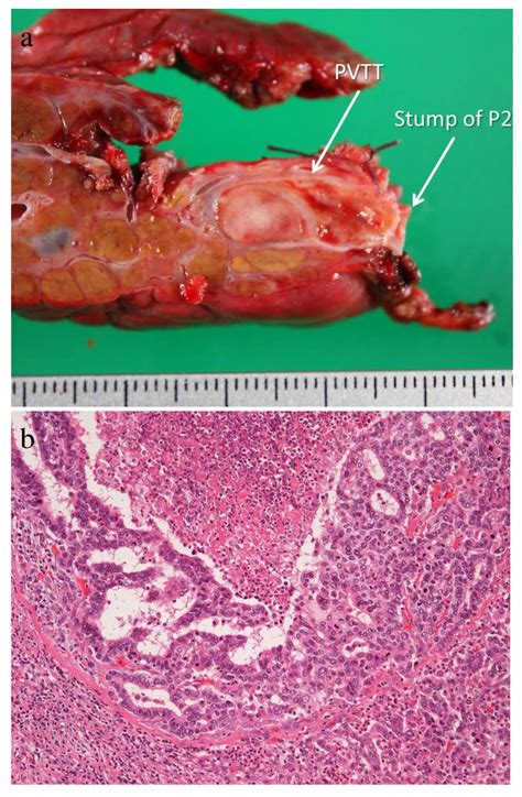 Anatomical Liver Segmentectomy 2 For Combined Hepatocellular Carcinoma