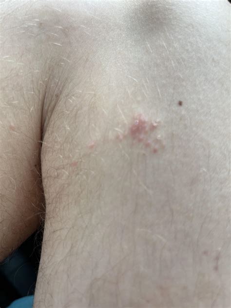 Confused By This Rash Its On My Leg Inner Thigh Near My Near R