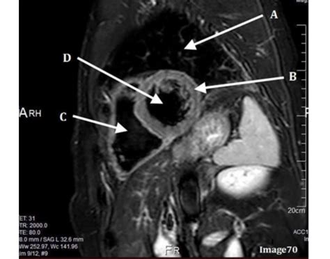 T2 Stir Short Axis Cardiac Mri Mriquiz 70 Quiz