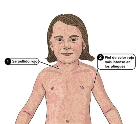 Síntomas De La Escarlatina Group A Strep Cdc