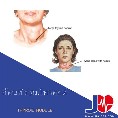 Thyroid Nodule Jia1669