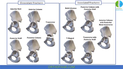 Acetabulum Fracture Full Explained Orthofixar 2025