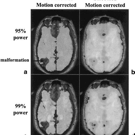 PDF Impact Of Signal To Noise On Functional MRI