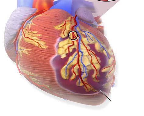 What Is Myocardial Ischemia Klarity Health Library