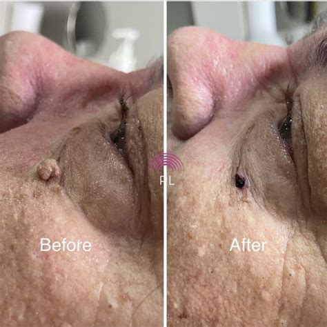 How To Safely Remove Skin Tags On Your Face Premier Beauty Salon Wigan