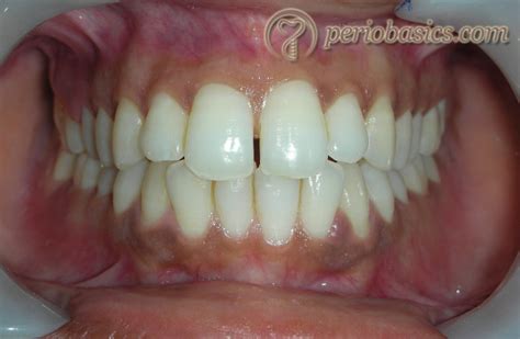 Festooned Gingival Contour At Andrea Newton Blog