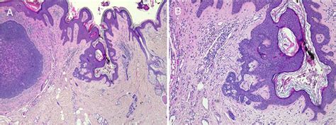Epidermal Nevus Histology