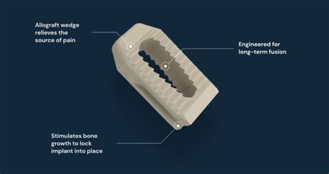 Get To Know LinQ The Revolutionary SI Joint Procedure PainTEQ LinQ Procedure For SI Joint