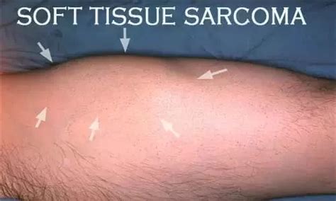 Soft Tissue Sarcoma Way To Heal