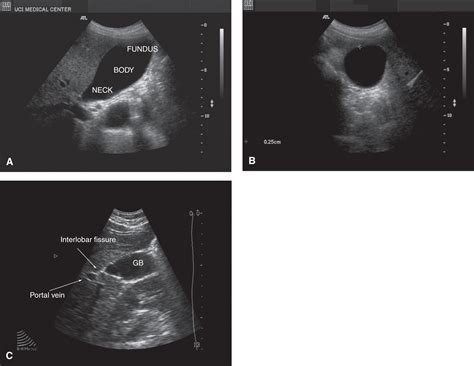 Gallbladder Anatomy Ultrasound