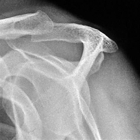 Acromion Types Mri