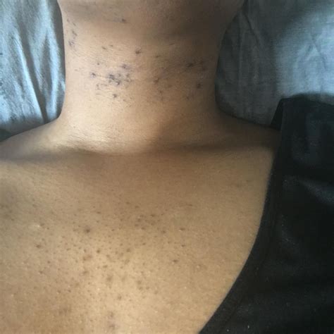 Skin Concerns Hyperpigmentation On Neck And Chest Am I Doomed R