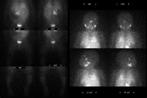 I 123 Mibg Cpt Code HomerJudd2 S Blog