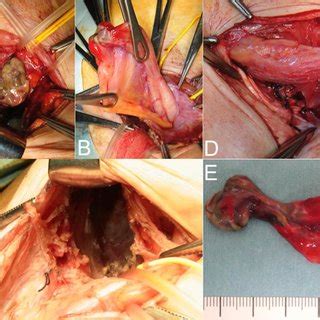 Sex Wise Distribution Of Histopathologic Features Of Appendix Download Table