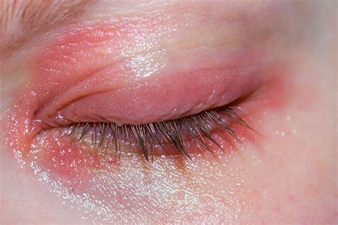 Blepharitis Eyelid Inflammation Symptoms And Treatment