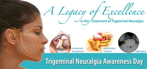 Trigeminal Neuralgia Mayfield Brain Spinal Column
