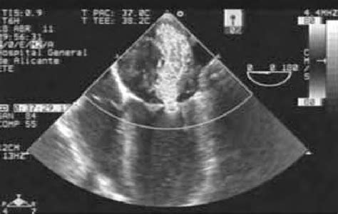 Ecocardiograma Insuficiencia Cardiaca Diferencias Entre Insuficiencia