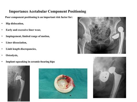 Acetabular Component Alignment Guide In Total Hip Replacement Ppt