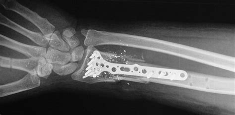 Hand And Wrist Acu Loc Wrist Plating System Acumed Distal Radius Fracture