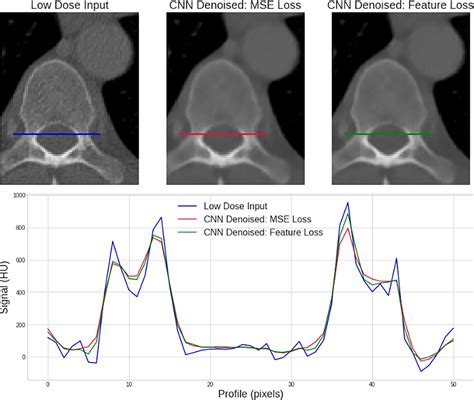 Magicians Corner Using Convolutional Neural Networks To Reduce Noise In Medical Images