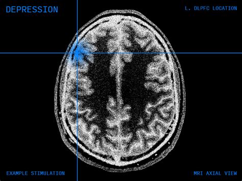 Tms Therapy A Better Faster Way To Treat Depression — Acacia Clinics
