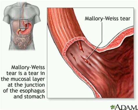 A Mallory Weiss Tears Occur In The Mucus Membrane Of The Lower Part Of