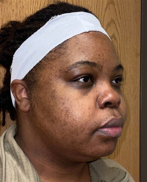 Chemical Face Peel Borealis Med Spa