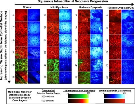 Multimodal Nonlinear Optical Microscopy Improves The Accuracy Of Early Diagnosis Of Squamous