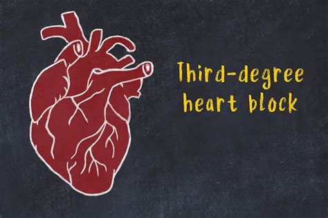 Understanding Third Degree Av Block