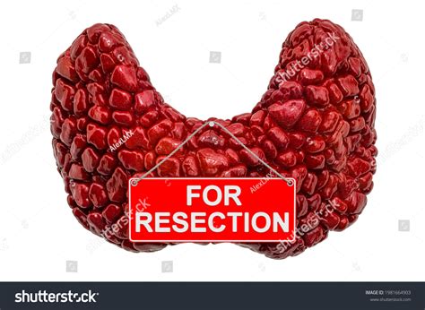 Thyroid Resection Hanging Sign 3d Rendering Stock Illustration
