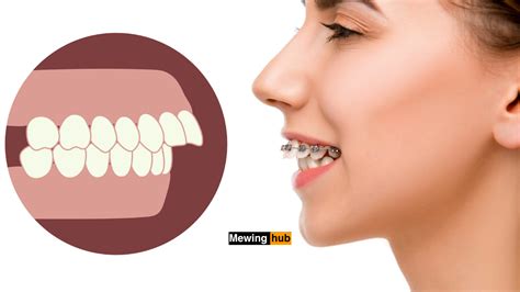 Normal Bite Vs Overbite Understanding The Differences And Their Impact Mewinghub