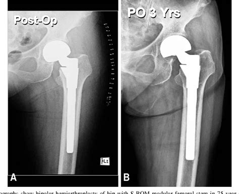 Figure 1 From Hip Arthroplasty Using Cementless Modular Femoral Stem For Displaced Femoral Neck