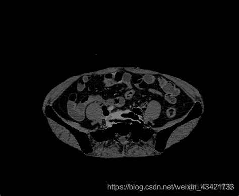 Python Vtk三维重建ct Image J 三维重建mob64ca1403c772的技术博客51cto博客
