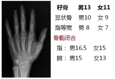 收藏：高清骨龄解析图谱，骨科医生临床必备！ 德医医学 助力医学教育发展！