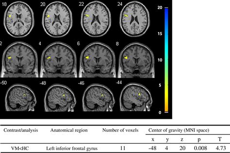 Significant Result From Intra Network Functional Connectivity Group