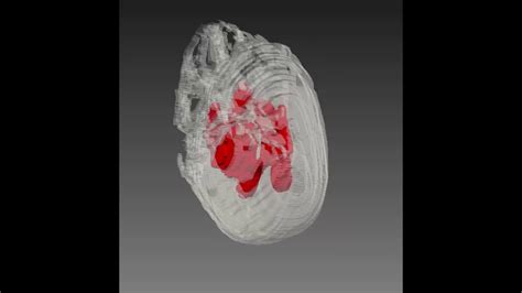 Intracranial Hemorrhage And Edema Segmentation Using Deep Learning By Rsip Vision Youtube