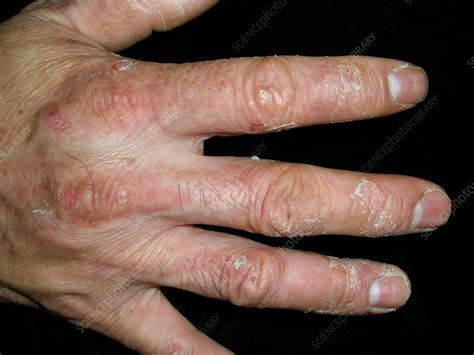 Contact Dermatitis Stock Image C0565400 Science Photo Library